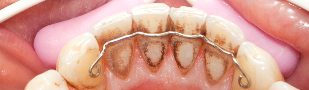 Airflow tooth polishing, whitening | Quirke Dental Surgeons